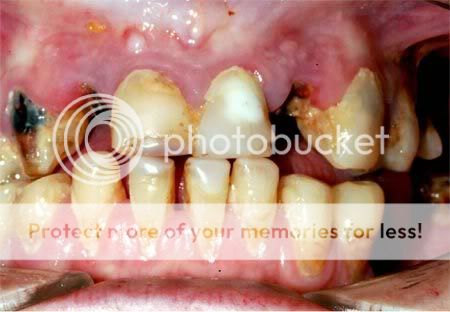 Nasty Teeth Pictures, Images & Photos | Photobucket